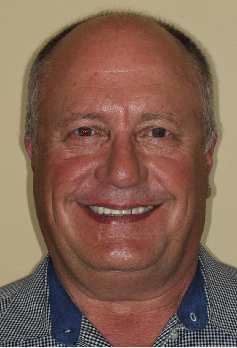 Dental Implants | Dentists in Nepean | Queensbury Dental Centre
