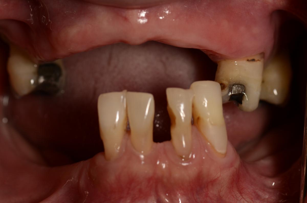 Teeth in A Day | Dentists in Nepean | Queensbury Dental Centre
