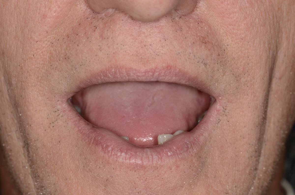 Teeth in A Day | Dentists in Nepean | Queensbury Dental Centre